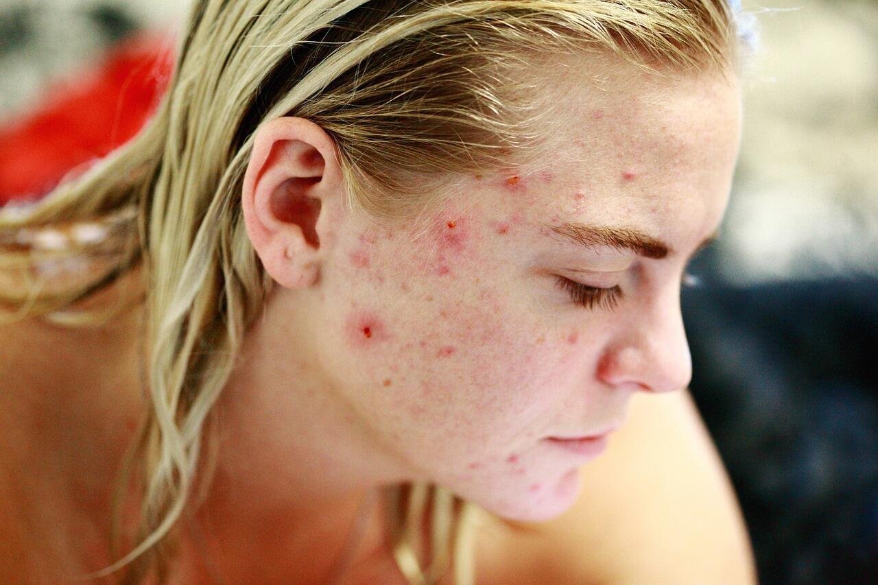 Acne on the Skin: Natural Remedies for Clearer Complexion - Discover ...