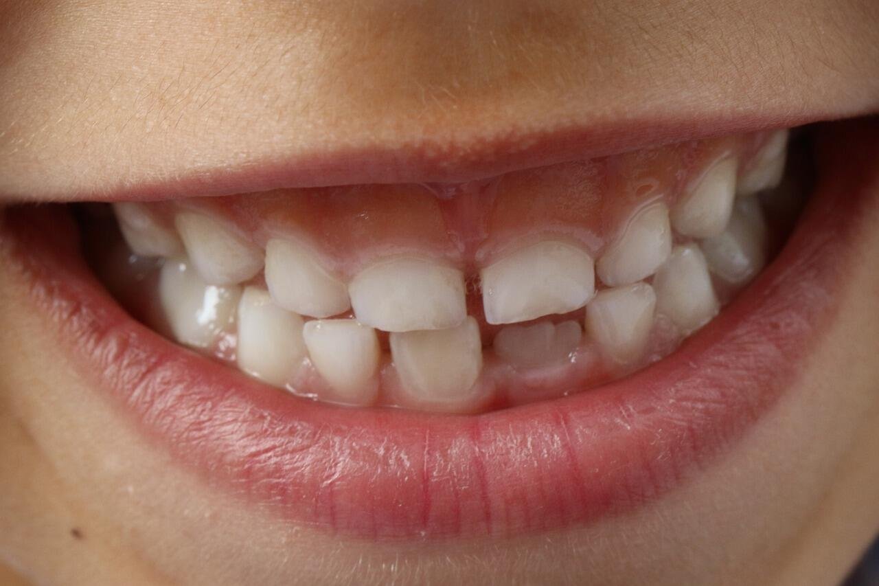 9 Effective Treatments for Buck Teeth You Need to Know - Discover the ...
