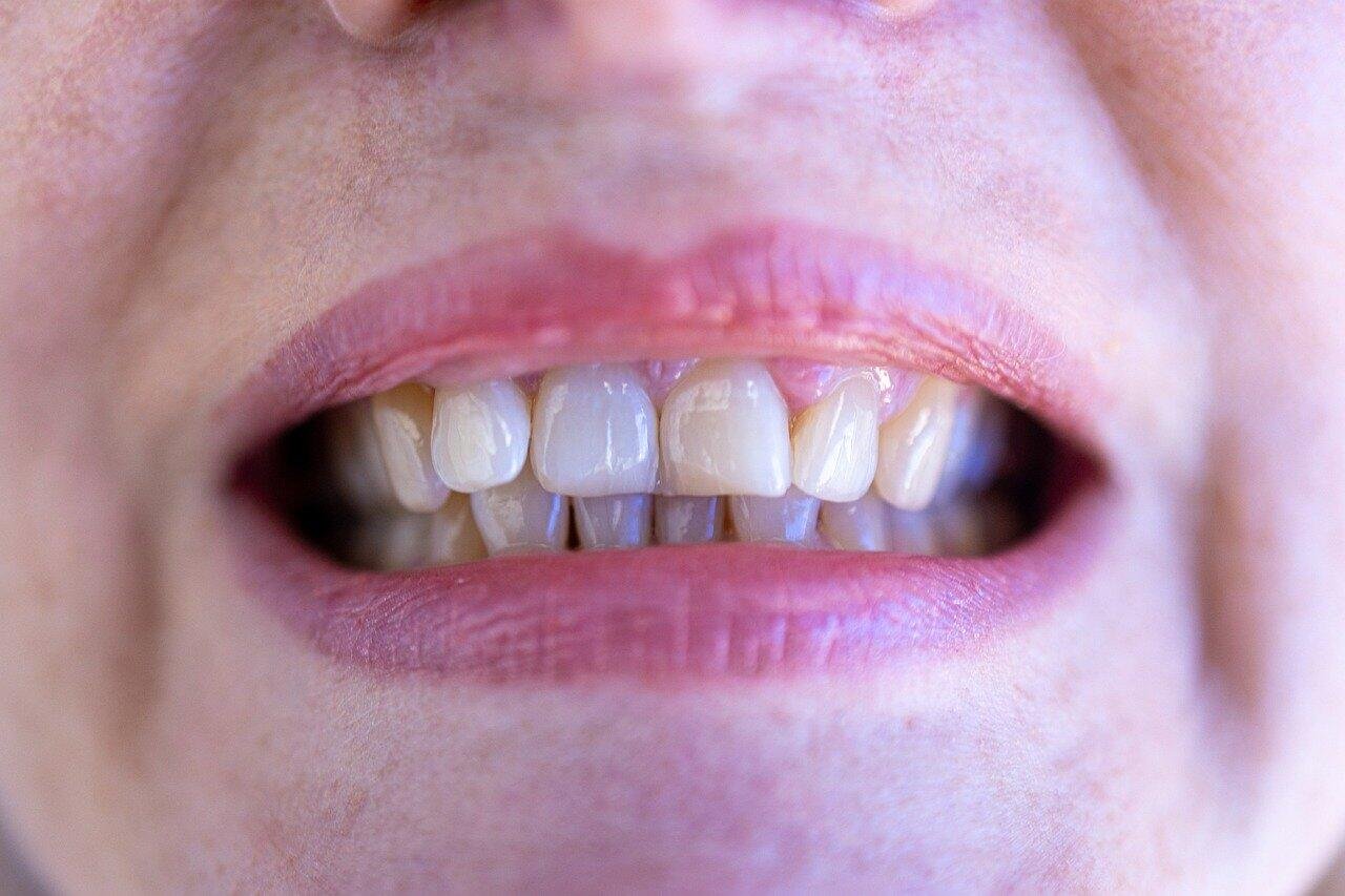 9 Effective Treatments for Buck Teeth You Need to Know - Discover the ...